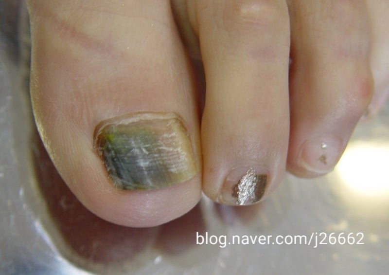 7. 녹색손발톱(Green nail syndrome / Chloronychia : 네이버 블로그