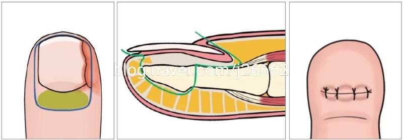 6. 내성장손발톱(감입손발톱, Ingrowing nail / Ingrown toenail) : 네이버 블로그