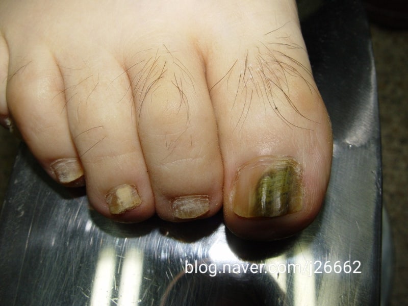 7. 녹색손발톱(Green nail syndrome / Chloronychia : 네이버 블로그