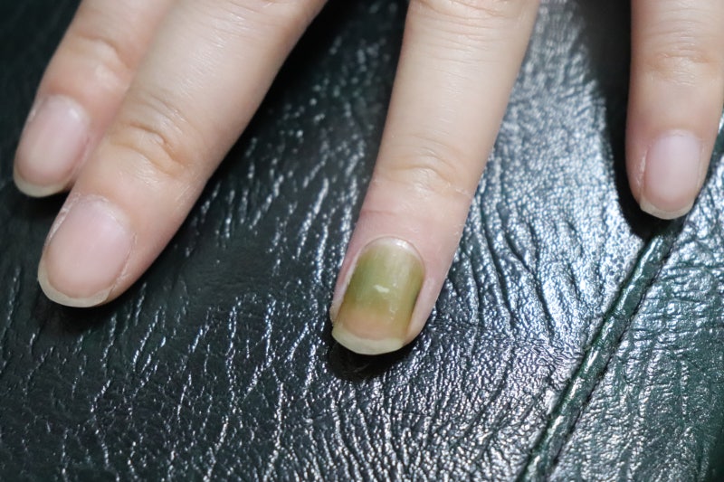 7. 녹색손발톱(Green nail syndrome / Chloronychia : 네이버 블로그