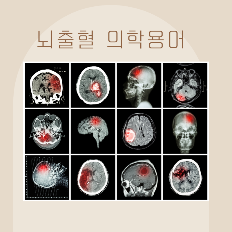 의학용어 ICH IVH EDH SDH SAH 뇌출혈 부위에 따라 : 네이버 블로그