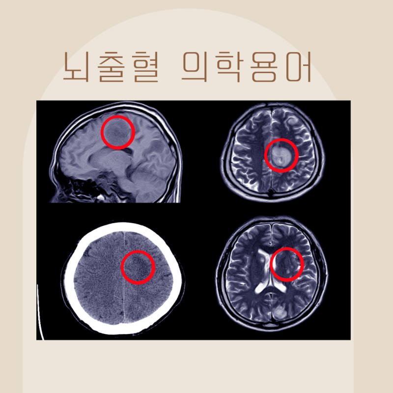의학용어 ICH IVH EDH SDH SAH 뇌출혈 부위에 따라 : 네이버 블로그