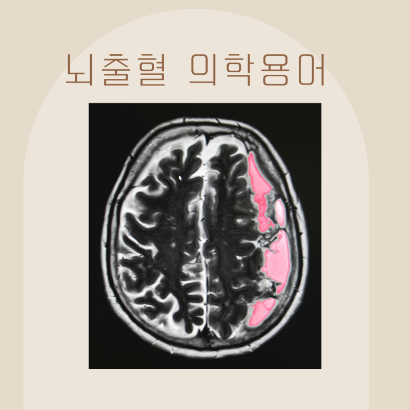 의학용어 ICH IVH EDH SDH SAH 뇌출혈 부위에 따라 : 네이버 블로그