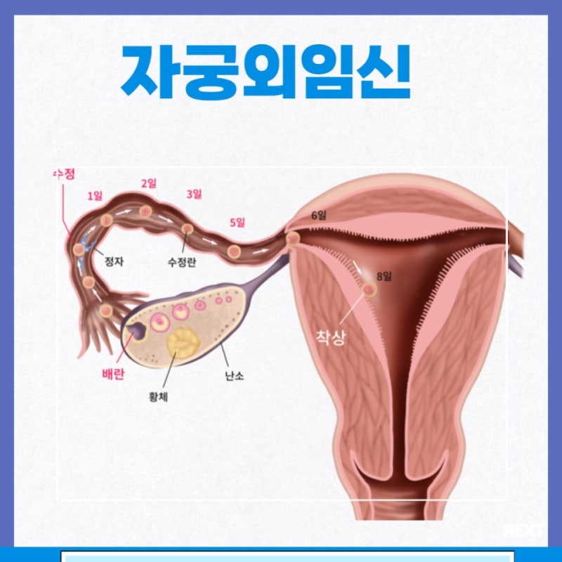 자궁외임신 증상 원인 통증 약물 수술방법 Mtx주사 네이버 블로그