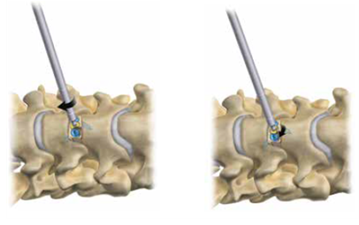 전방 경추 수술 - ACDF(Anterior cervical discectomy and fusion ; 전방 경추 추간판 제거 ...