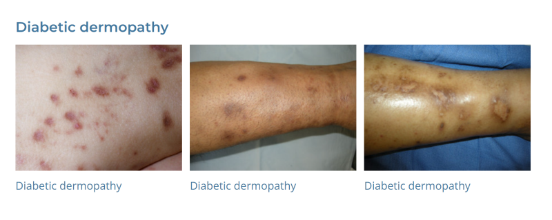 당뇨병피부병증, diabetic dermopathy 의 모습을 관찰/설명함 - 동대문구 답십리, 장안동, 우리안애 우리안愛 내과 ...