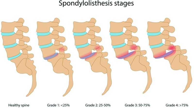 척추전방전위증(Spondylolisthesis) 원인, 증상, 분류, 치료 방법의 모든 것 : 네이버 블로그