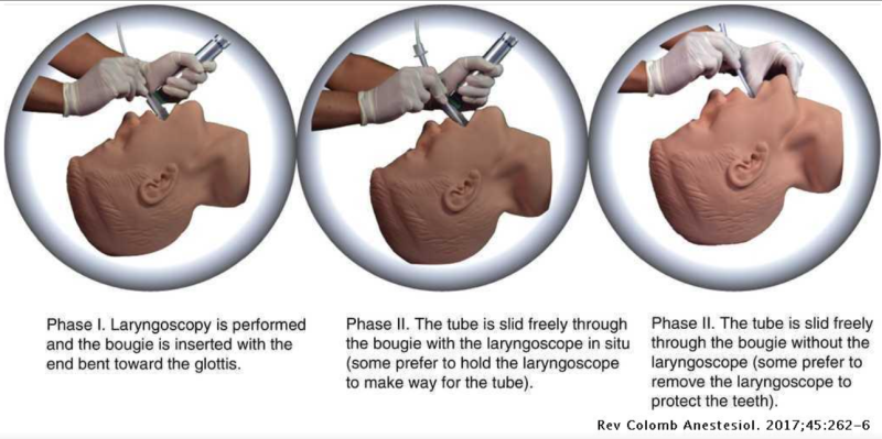 부지를 활용한 기도 삽관 (Bougie intubation) : 네이버 블로그