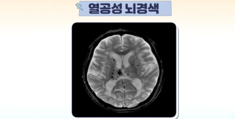 호수손해사정 진구성 열공성 뇌경색 또한 뇌경색 I63 에 해당 함 네이버 블로그