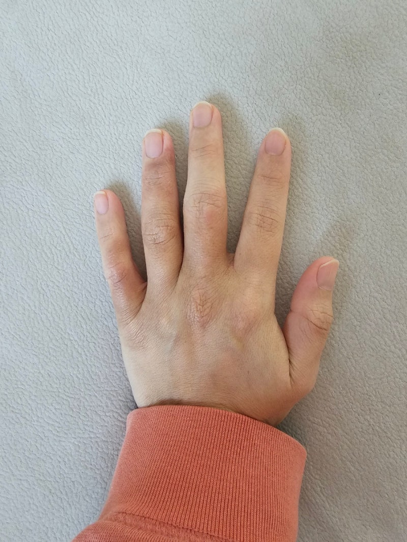 손가락 한포진 완치한포진치료 약없이완치 항생제 항히스타민부작용 네이버 블로그
