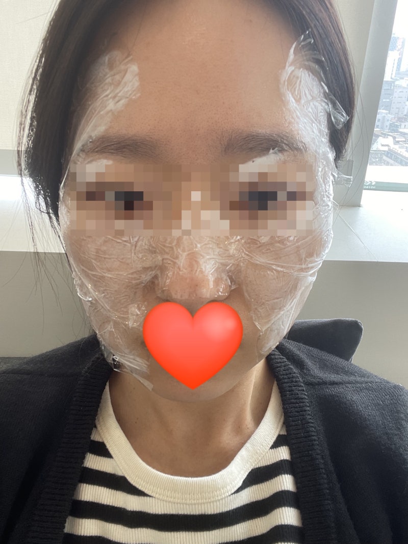 흑자 제거 루비레이저 압구정 라움성형외과 피부과 레이저 시술후기 일광성흑자 단순흑자 임신으로 인한 색소침착 네이버 블로그