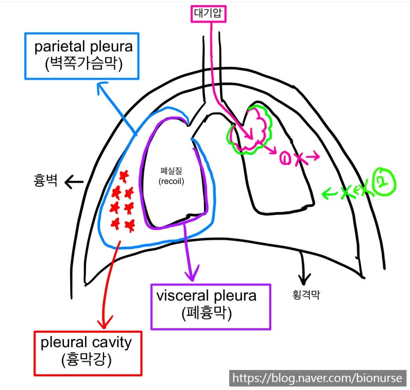 질병 간호 기흉pneumothorax간호진단 네이버 블로그