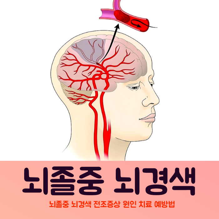 뇌졸중 뇌경색 전조증상 초기증상 원인 치료 골든타임 네이버 블로그