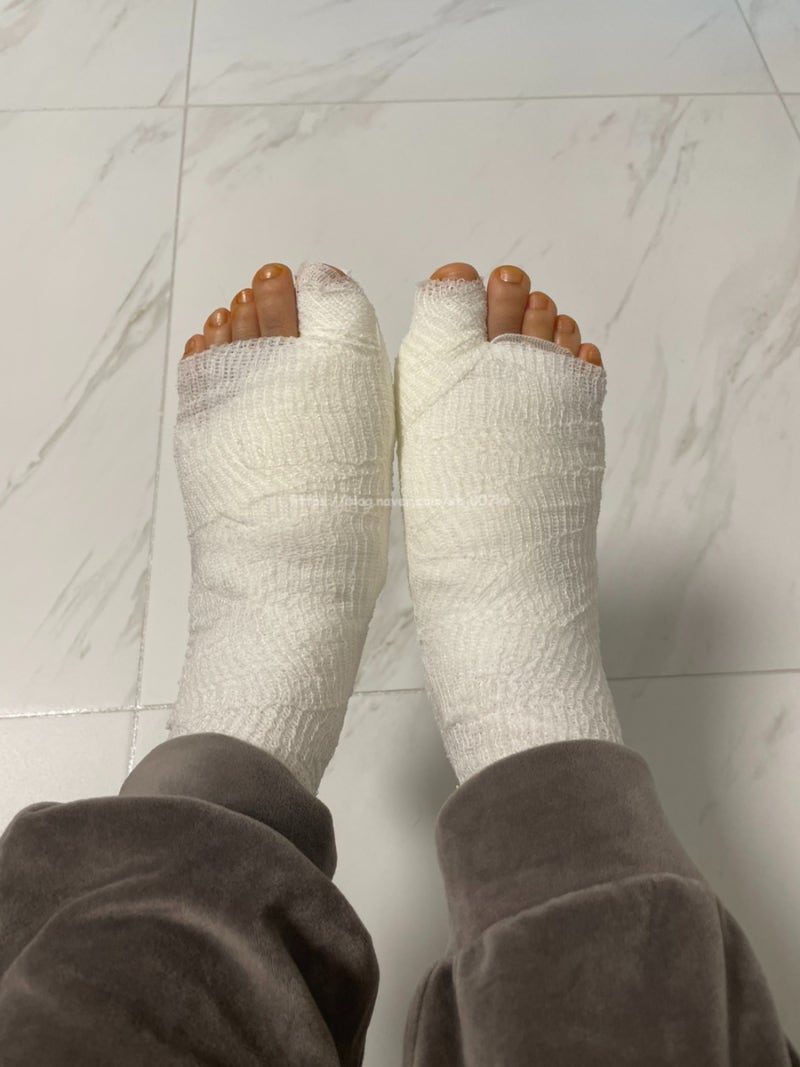 무지외반증 최소침습 Mica 수술 후기 8일차 병원방문feat소독사진 네이버 블로그