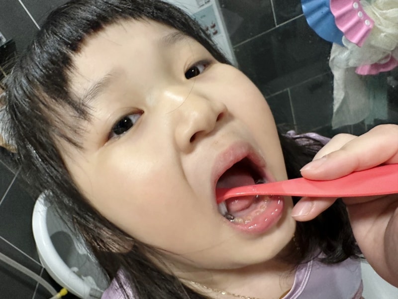 법랑질형성부전증 6살 아이에게 맞는 칫솔 고르기 칫솔추천 네이버 블로그