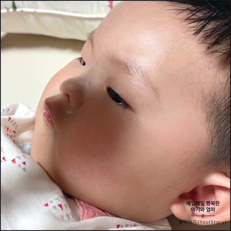 아기 얼굴 상처 피날 때 관리팁 메디폼 에스로반 비판텐 연고 사용 방법 네이버 블로그