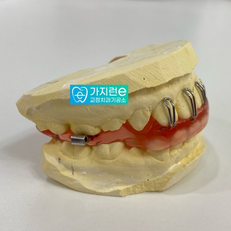 토이셔장치(Teuscher) : 네이버 블로그