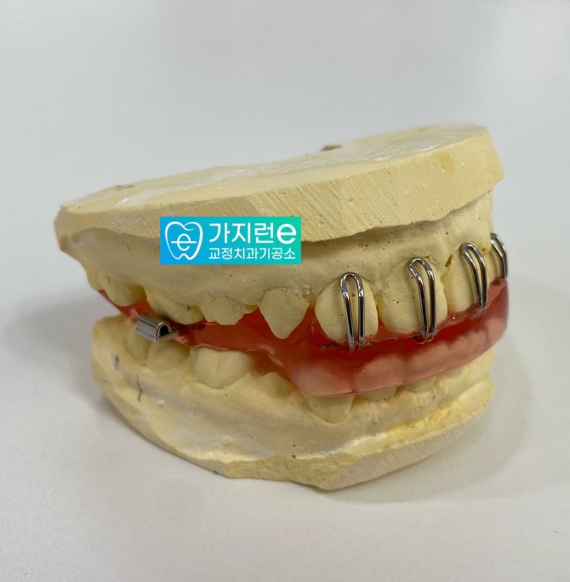 토이셔장치(Teuscher) : 네이버 블로그