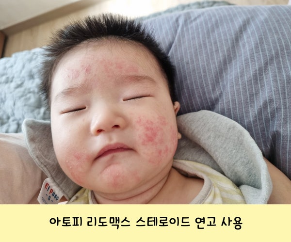 4개월아기 아토피 리도맥스 사용 후기 스테로이드 연고 등급 네이버 블로그