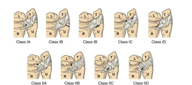 TFCC injury ｜ tfcc 손상 정도, tfcc 구조에 대해서 -1 : 네이버 블로그