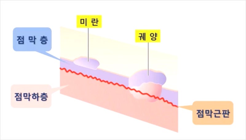 미란성위염 위암되기전에 원인 증상 예방법알아보기 네이버 블로그