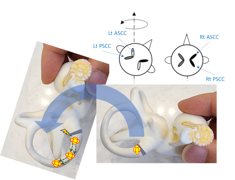 [BPPV] PSCC Cupulolithiasis의 liberation maneuver로써 Semont maneuver를 활용해 ...