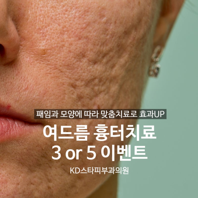 강동구 여드름 흉터 치료 피부과모양과 패임에 따른 맞춤 치료 네이버 블로그