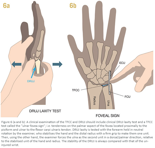 TFCC injury ｜ tfcc치료 방법 선택 어떻게 하나요? [보존적 치료 vs 수술] -2 tfcc 한의원 : 네이버 블로그