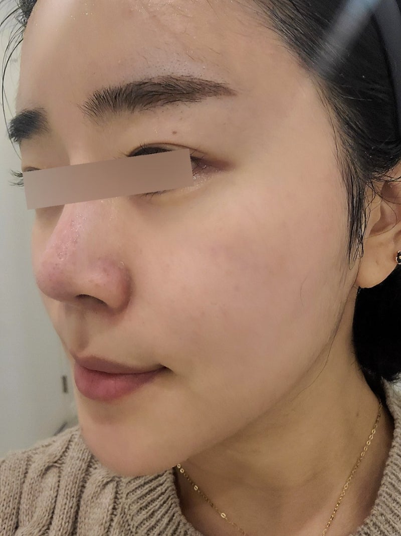 강남 피부과물광주사스킨부스터 릴리이드m맞고 온 실제후기 물광주사 가격붓기통증효과 등 리쥬란 힐러와 차이사진o