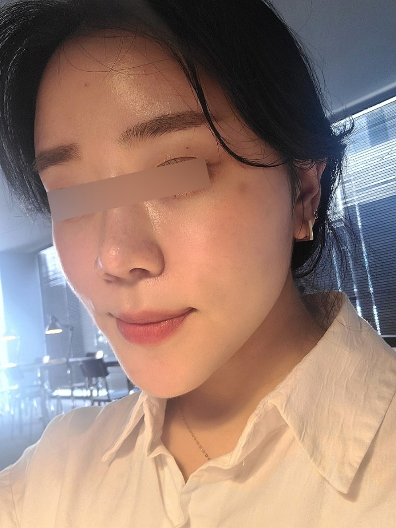 강남 피부과물광주사스킨부스터 릴리이드m맞고 온 실제후기 물광주사 가격붓기통증효과 등 리쥬란 힐러와 차이사진o