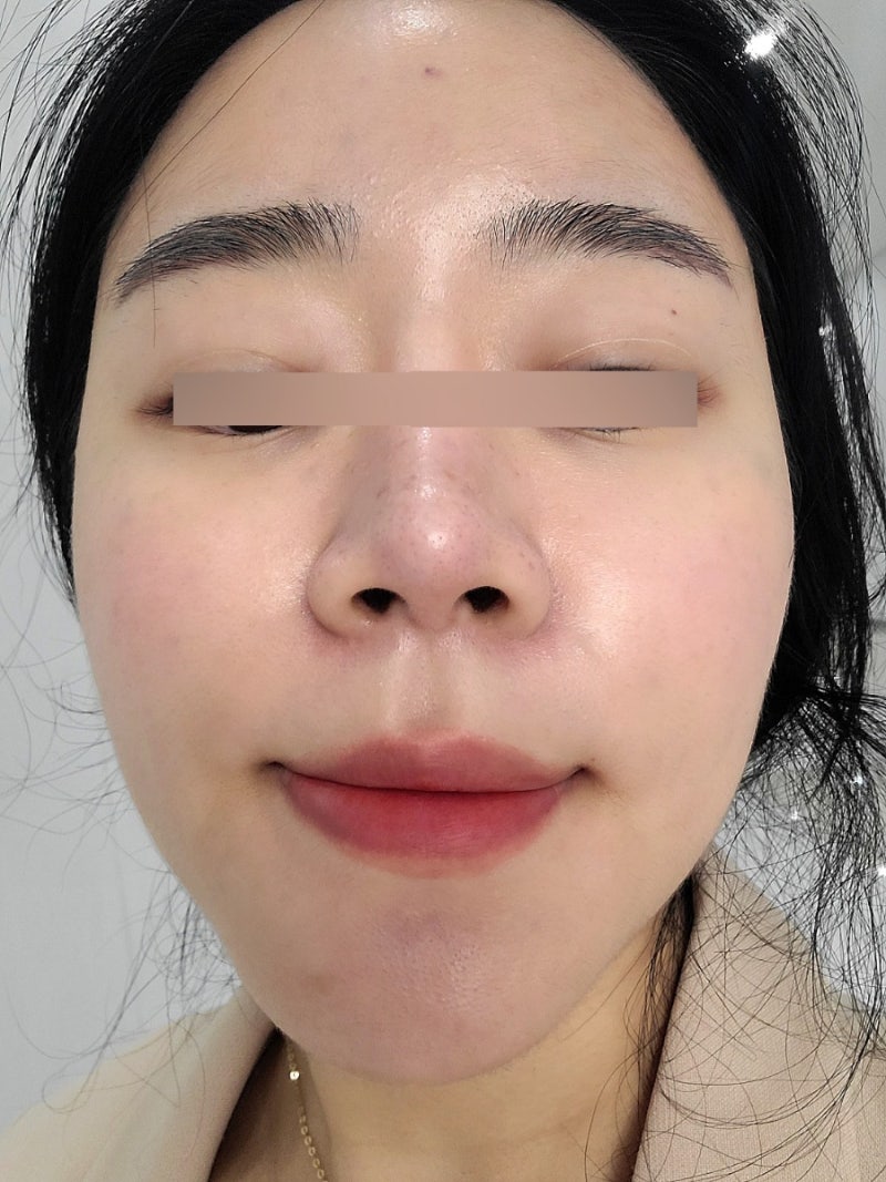 강남 피부과물광주사스킨부스터 릴리이드m맞고 온 실제후기 물광주사 가격붓기통증효과 등 리쥬란 힐러와 차이사진o