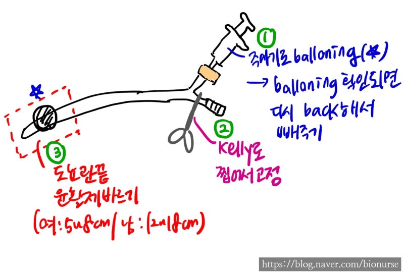 핵심 술기 유치도뇨 술기대사 네이버 블로그