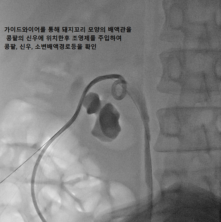 경피적 신루설치술pcnpercutaneous Nephrostomy의 궁금증 백문백답 네이버 블로그