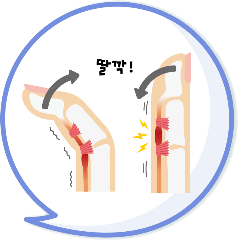 손가락 통증 방아쇠수지증후군 손가락 안 펴짐 딸깍 걸리는 느낌 등 증상 및 치료 네이버 블로그