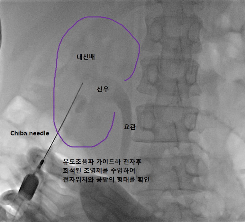 경피적 신루설치술pcnpercutaneous Nephrostomy의 궁금증 백문백답 네이버 블로그