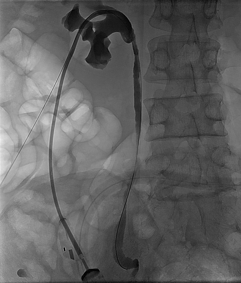 경피적 신루설치술pcnpercutaneous Nephrostomy의 궁금증 백문백답 네이버 블로그