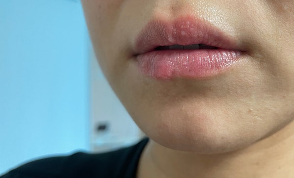 입술 포진 입술 수포 치료 후기 및 빨리 낫는 방법 추천 지긋지긋한 헤르페스 1형혐오 사진 있음 주의 네이버 블로그
