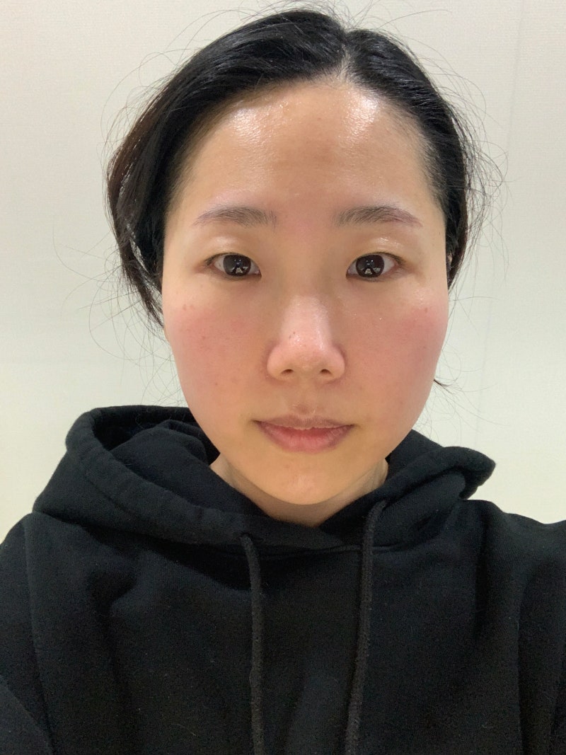 볼뉴머 슈링크유니버스 고주파리프팅 구로피부과 볼링크 관리 후기 네이버 블로그