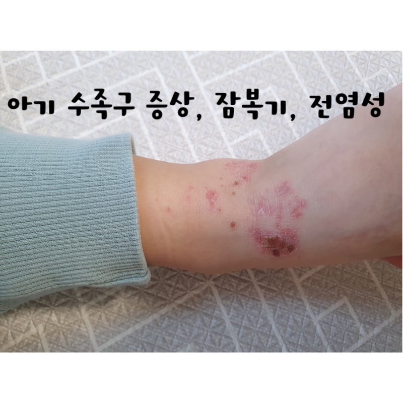아기 수족구 증상과 잠복기 전염성 알아보기 완치확인서 받기 네이버 블로그
