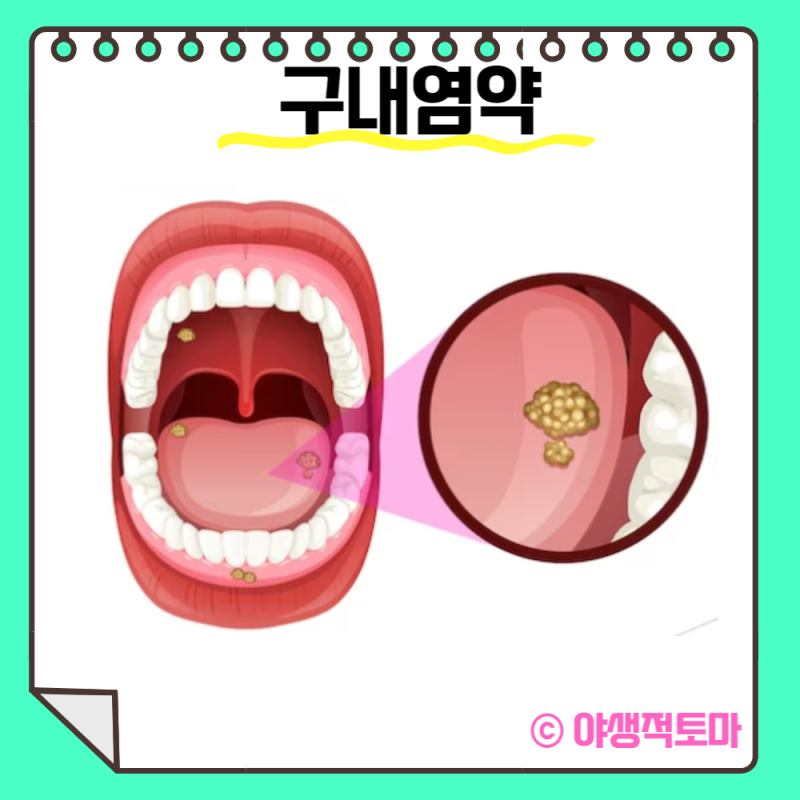 구내염약 알보칠 Vs 페리덱스 성분 작용기전 효능 부작용 Feat 페리터치 오라메디 네이버 블로그