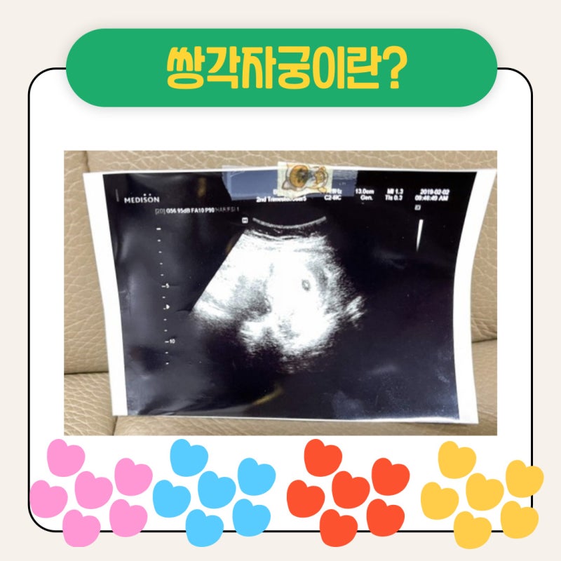 쌍각자궁 임신 초산 유도분만 실패 제왕절개 출산후기 네이버 블로그