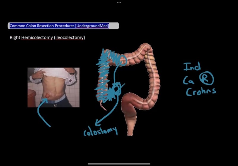 장루 주머니 Colostomy , Ileostomy : 하트만 수술 공부하기 (Hartmann's Procedure) : 네이버 블로그