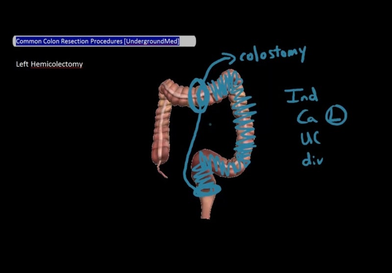 장루 주머니 Colostomy , Ileostomy : 하트만 수술 공부하기 (Hartmann's Procedure) : 네이버 블로그