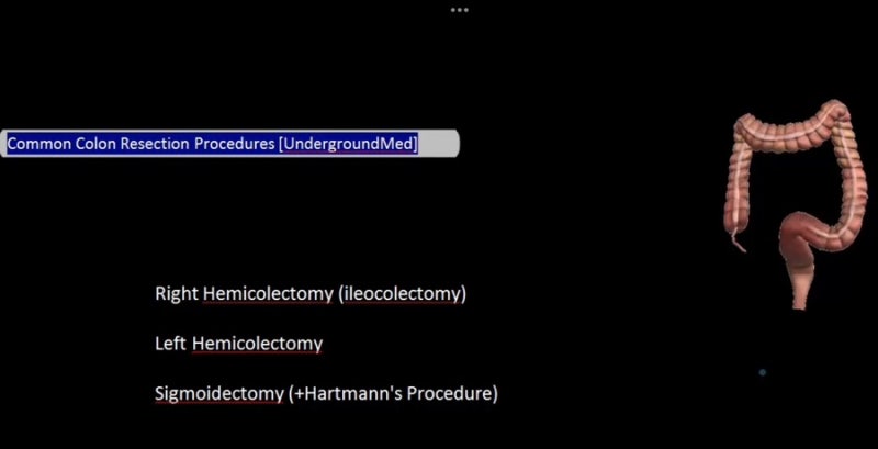 장루 주머니 Colostomy , Ileostomy : 하트만 수술 공부하기 (Hartmann's Procedure) : 네이버 블로그