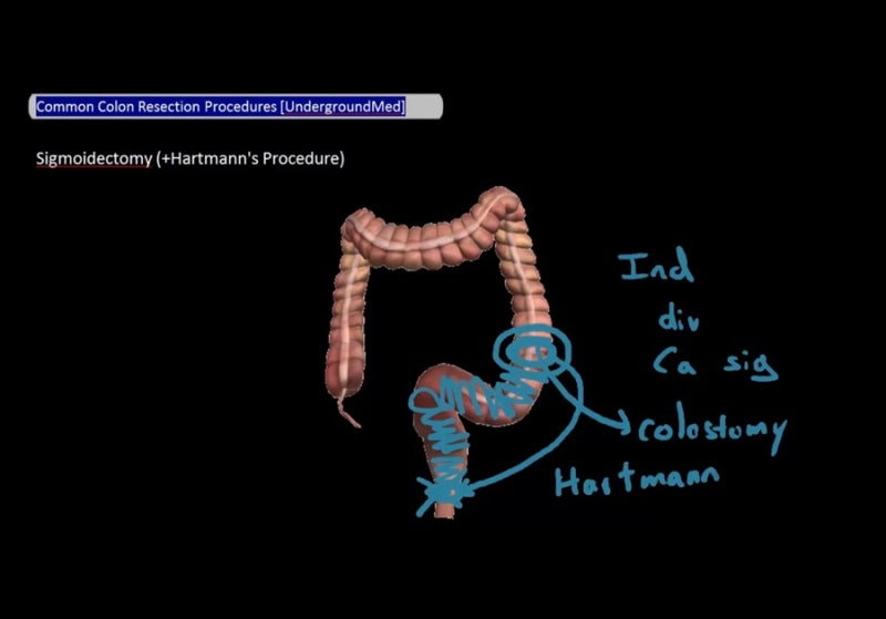 장루 주머니 Colostomy , Ileostomy : 하트만 수술 공부하기 (Hartmann's Procedure) : 네이버 블로그