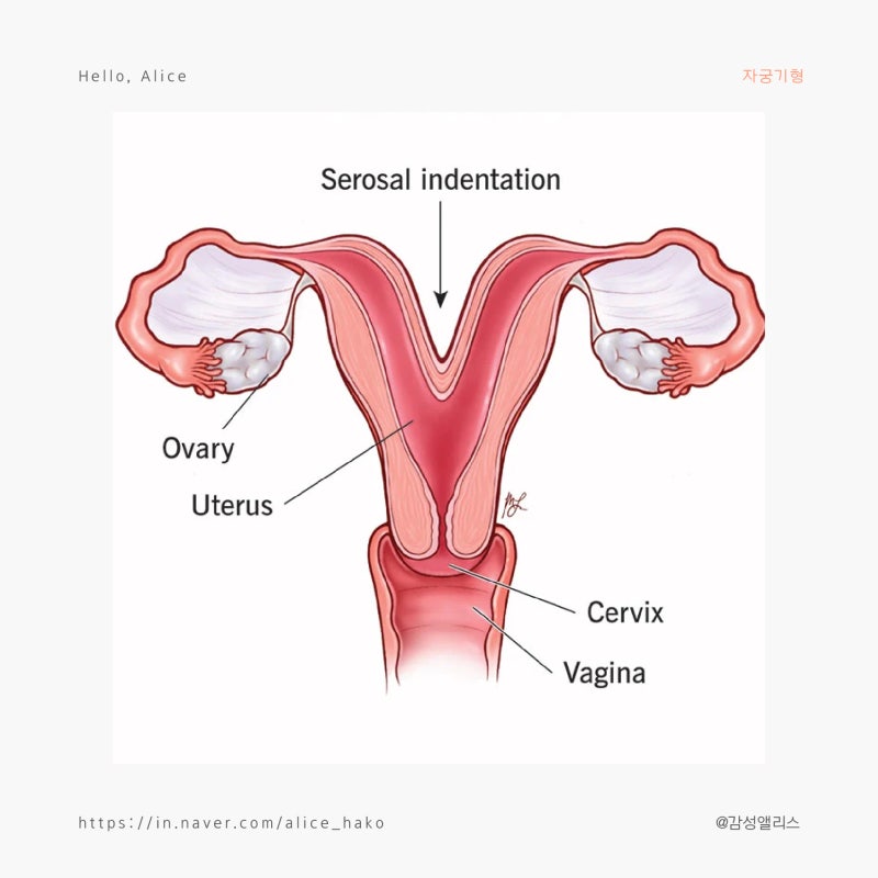 쌍각자궁과 중격자궁 선천성 자궁기형에 대해 네이버 블로그