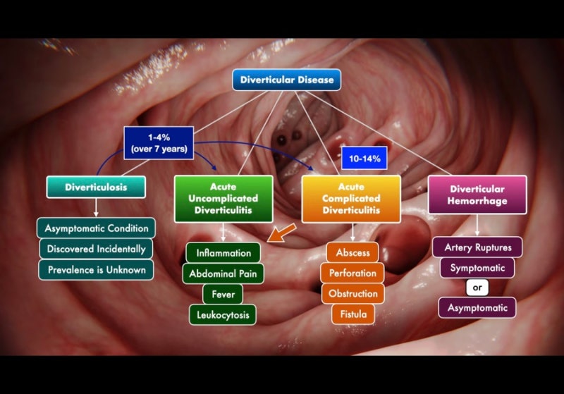장루 주머니 Colostomy , Ileostomy : 하트만 수술 공부하기 (Hartmann's Procedure) : 네이버 블로그