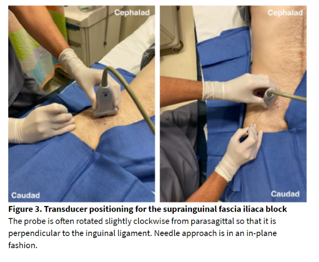 [정형외과 전문의] 하지 신경차단술 (Femoral n block~ankle block etc.) : 네이버 블로그