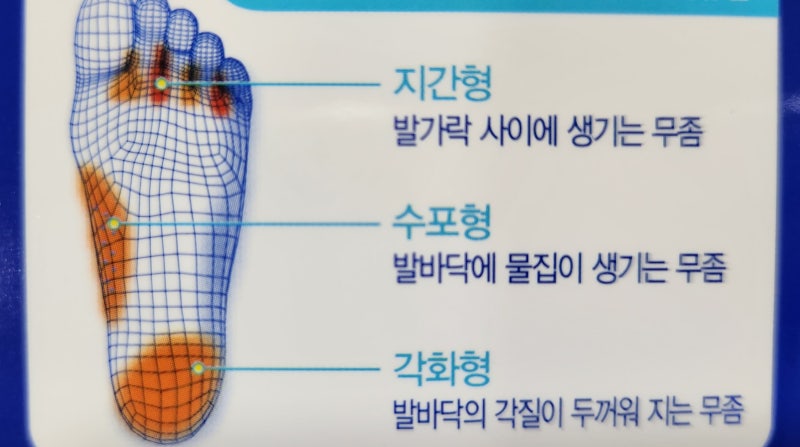 약국 무좀약 추천 바르는무좀약 지간형무좀약 가려울 때 쓰는 무좀연고 따로 있다 네이버 블로그