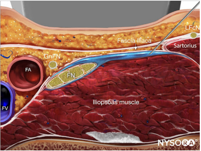 [정형외과 전문의] 하지 신경차단술 (Femoral n block~ankle block etc.) : 네이버 블로그